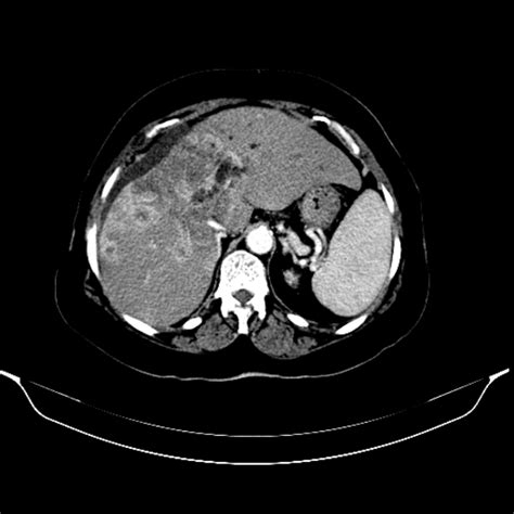 Cholangiocarcinoma Image