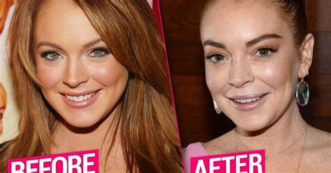 Lindsay Lohans Plastic Surgery Makeover Exposed By Top Docs