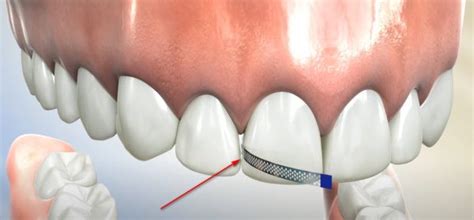 Interproximal Reduction Ipr In Orthodontics