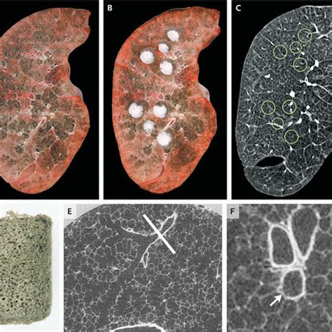 Schematic Diagram Of Cell Tissue Level Interactions In Copd In Copd