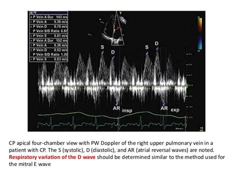 Echo Differentiation Of Restrictive Cardiomyopathy And Constrictive P…