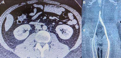 A Retention Of Non Conical Filter For 6 Years Fractured B Ivc