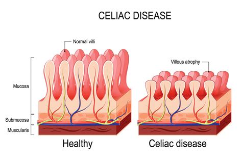 Celijakija Simptomi Dijagnoza I Prehrana