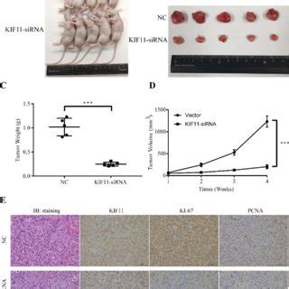KIF11 Is Expressed At High Levels In Gallbladder Cancer Compared With