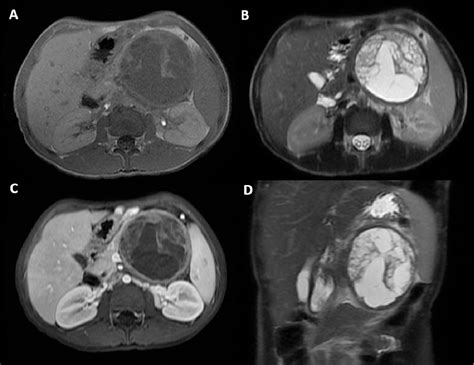 Figure 1 From Pancreas Cystic Solid Pseudopapillary Tumor Frantzs