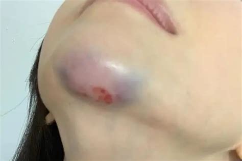 下巴打完玻尿酸淤青图