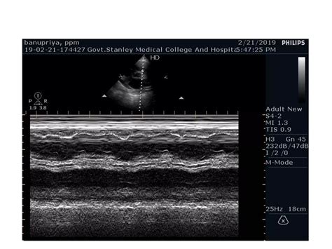 Pulmonary Hypertension Echo Pptx