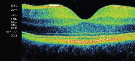 Retinal Regeneration As Illustrated By Sd Oct Retinal Physician