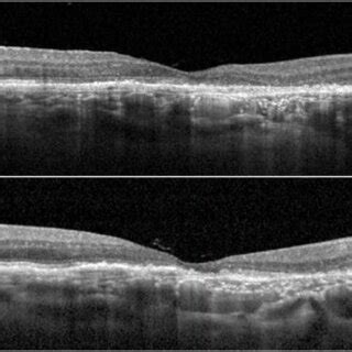 A And B Macular OCT Of The RE In The Last Visit 6 Months After Download Scientific Diagram