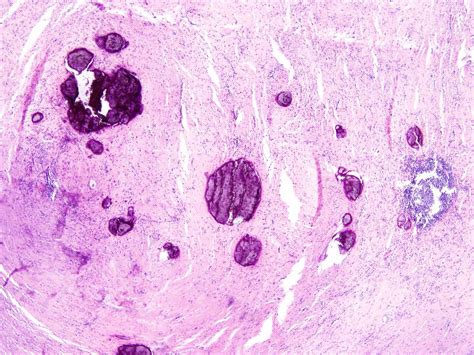 Pathology Outlines Calcifying Fibrous Tumor
