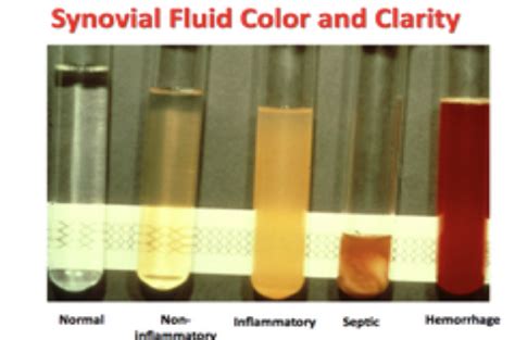 Serosanguinous Fluid Color
