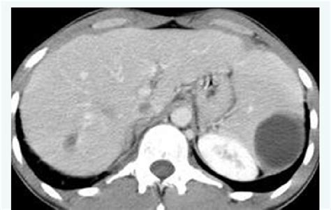 Show Ct Scan Of Abdomen And A Cyst In The Lower Pole Of Spleen