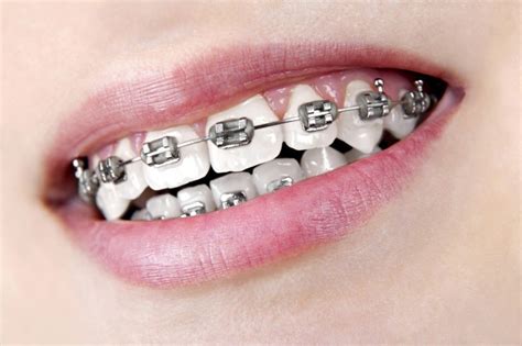 Braces And White Spots On My Teeth Orthodontic Associates