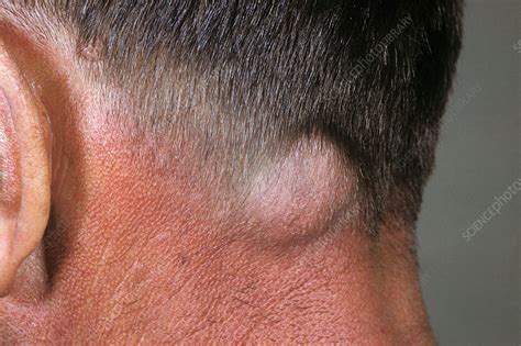 Secondary Lymph Node Cancer Stock Image C0294616 Science Photo Library