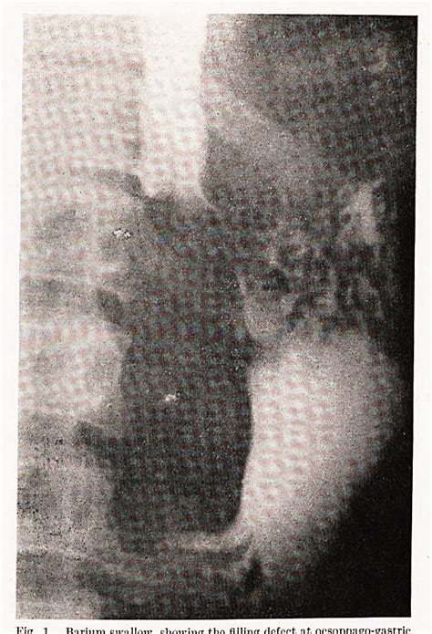 Figure 1 From A Case Of Generalized Scleroderma Simulating Oesophageal Carcinoma Semantic Scholar