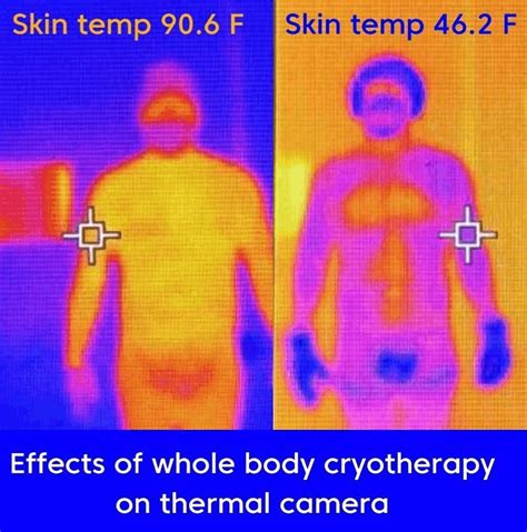 How Does Cryotherapy Work