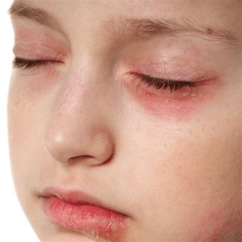 Dermatomyositis Face