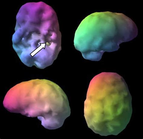 Outside Surface Scan Severe Left Temporal Lobe Hypoperfusion Arrow Download Scientific Diagram