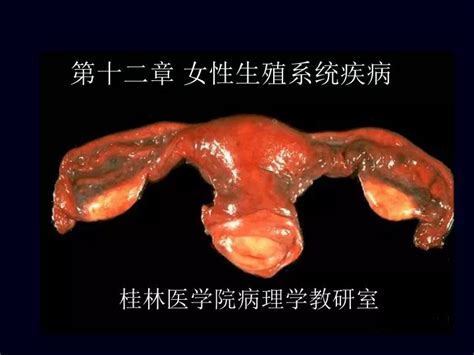 Ppt 第十二章 女性生殖系统疾病 Powerpoint Presentation Free Download Id4972422