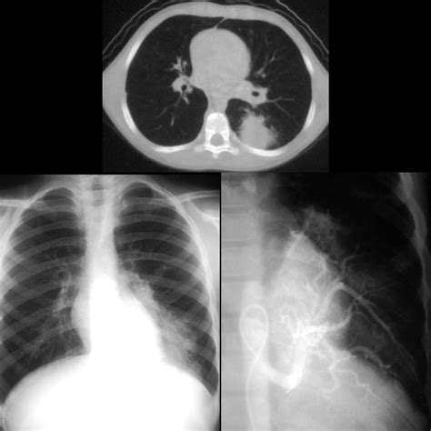 Pulmonary Sequestration Pediatric Radiology Reference Article