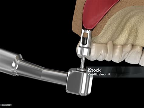 부비동 리프트 수술 부비동에 대한 액세스를 만들기 3d 일러스트레이션 3차원 형태에 대한 스톡 사진 및 기타 이미지 3차원