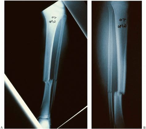 Intramedullary Tibial Nailing Teachme Orthopedics