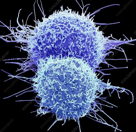 Colorectal Cancer Cells SEM Stock Image C053 3126 Science Photo