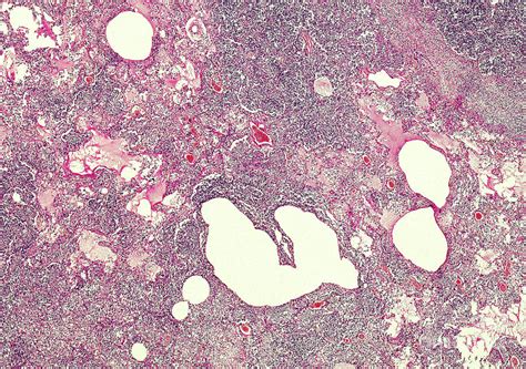 Acute Fibrinous Pleuritis Photograph By Nigel Downer Science Photo