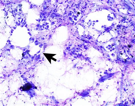 Pathology Outlines Diffuse Mesothelioma Pleura