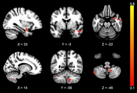 Brain Activity Positively Correlated With Tsk‐11 Scores During The