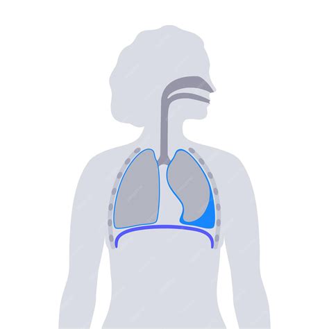 Premium Vector Pleural Effusion Poster