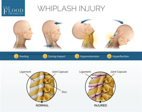 Neck Injuries From Car Accident Call A Car Accident Lawyer Today