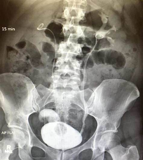Cystogram 15 Minutes After Contrast Introduction Showing Bladder