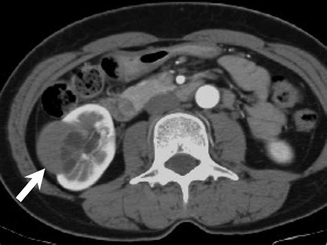 Case 1 A 58 Year Old Woman With An Epithelial And Stromal Tumor Of The