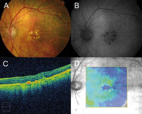 Optical Coherence Tomography In Age Related Macular Degeneration