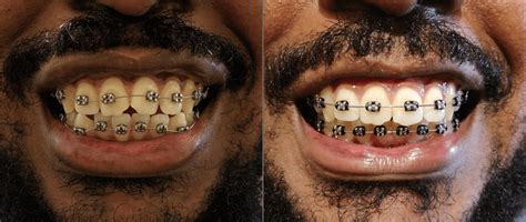 Dear People Who Hadhave Bite Blocks On Your Teeth How Do You Eat