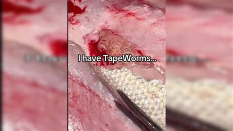 Man Deliberately Eats Tapeworms For Social Media Likes Ends Up With Deadly Side Effects