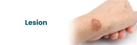 Understanding Lesions Types And Treatment