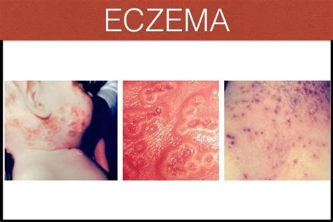 Eczema o que é sintomas causas e tratamento Tua Saúde
