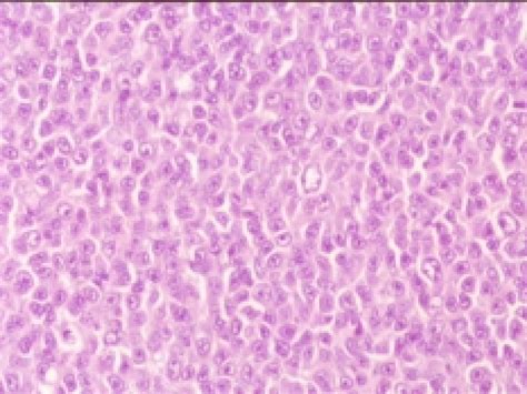 Photomicrograph Showing Typical Morphology Of Dlbcl Note Marked