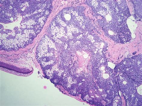 Histologic Images Showing Dermal Nodules Of Basaloid Cells Admixed With