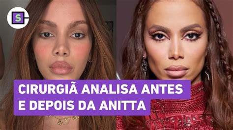 Anitta Antes E Depois Cirurgiã Dentista Fala Possíveis Procedimentos