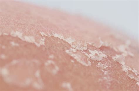 Texture Of Irritated Reddened Skin With Flaking Scales And Cracks From