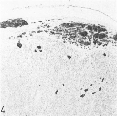 Nevocellular Nevus Of The Lymph Node Capsule S 100fl Nevus Cells Form Download Scientific