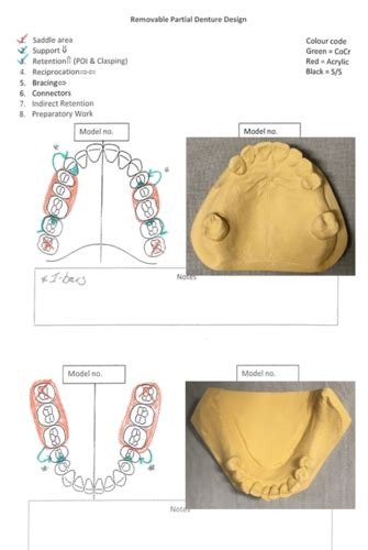 Removable Partial Denture Design Flashcards Quizlet