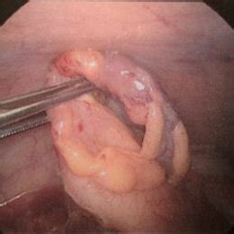 Intraoperative Photograph Laparoscopic Appendicectomy Inflamed Download Scientific Diagram