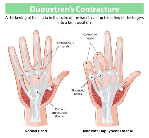 Free Vector Dupuytrens Contracture Illustration