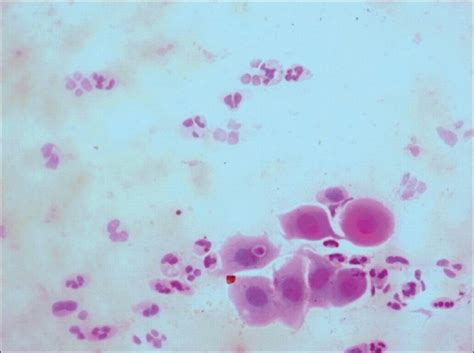 Metaplastic Squamous Cells With Eosinophilic Intracytoplasmic Inclusion