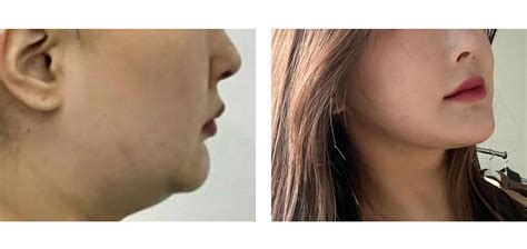 파워v얼굴지방흡입 이중턱 근육묶기 15개월차 후기 닥터정 리반의원