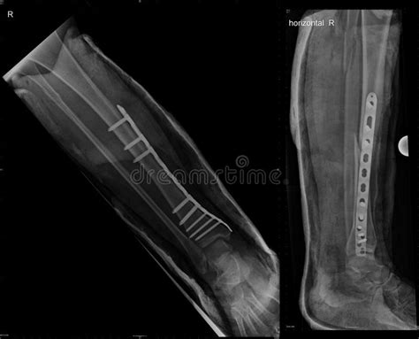 Osteosynthesis Do Osso Tibial Fraturado Imagem De Stock Imagem De